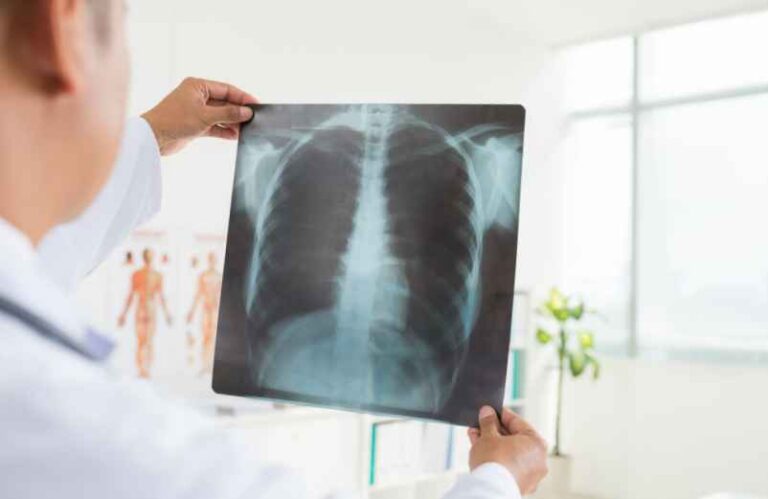 Embolie pulmonaire : symptômes, causes et traitement - FFAT Santé